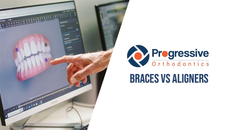 Invisalign® Clear Aligners | FL Invisalign Orthodontists